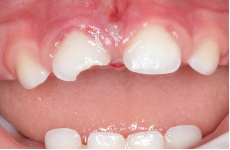 ¿Cómo actuar ante un traumatismo dental? - Galván Kids